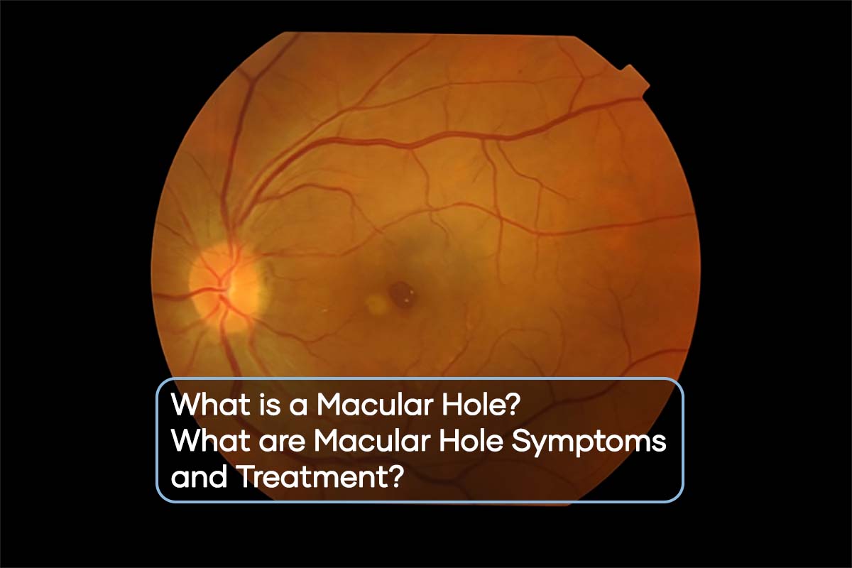 What Is A Macular Hole In Your Eye - Infoupdate.org