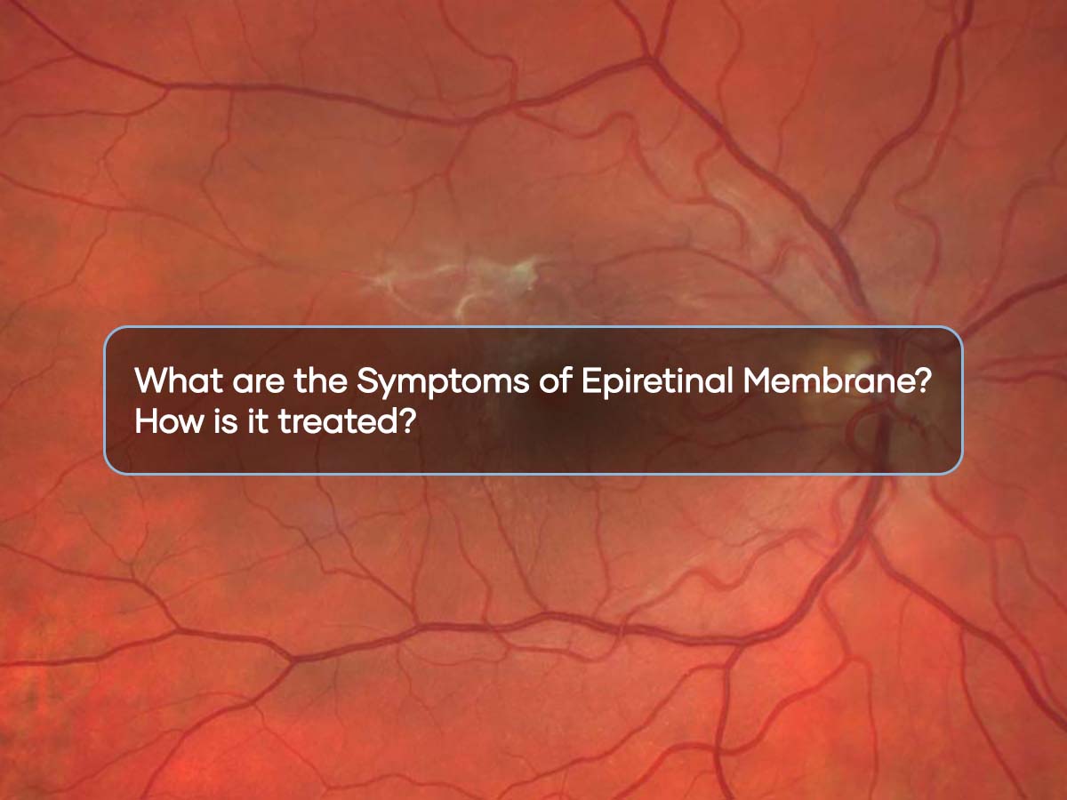What are the Symptoms of Epiretinal Membrane? How is it treated?